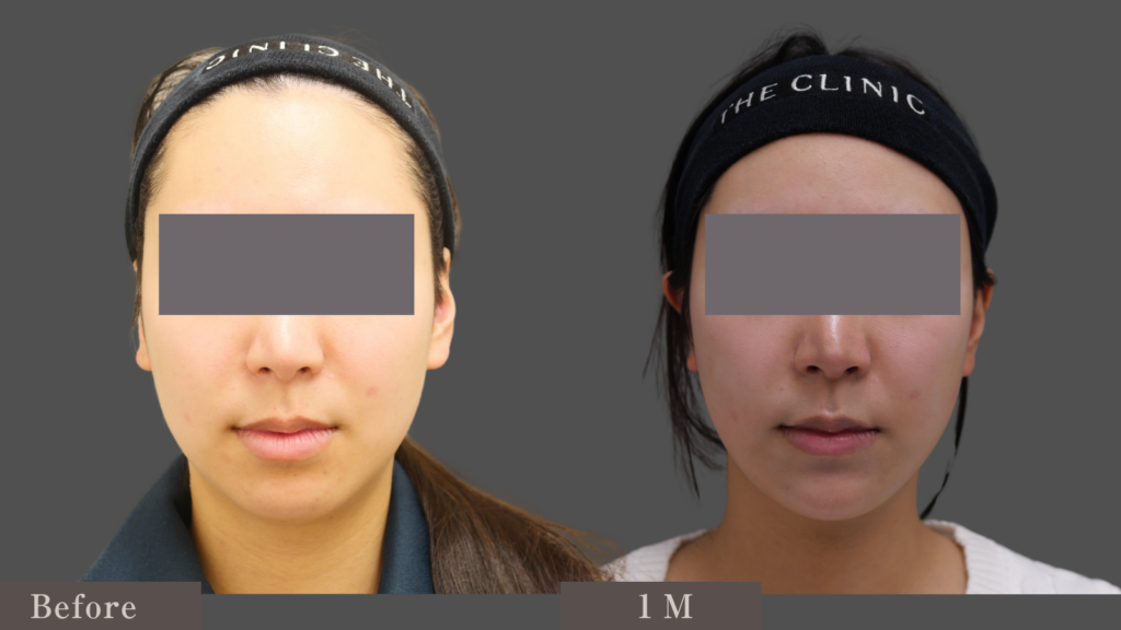 脂肪吸引（頬・顎下）と糸リフト（VOV4本）の1ヶ月後経過 | 黒澤学 美容外科医ブログ｜脂肪吸引・豊胸・エイジング治療